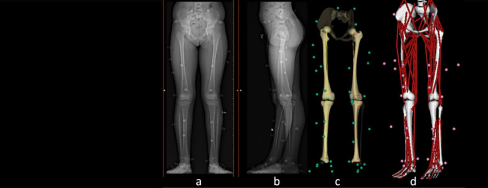 From clinical gait analysis to clinical musculoskeletal modelling ...